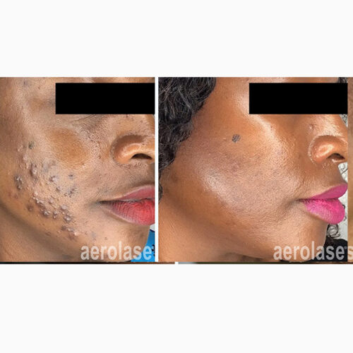 Neo Elite Aerolase Laser in Los Angeles, CA | Ginille Beauty