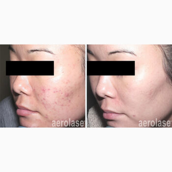 Neo Elite Aerolase Laser in Los Angeles, CA | Ginille Beauty